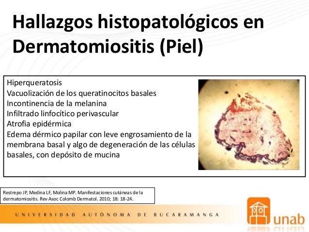 Caso clínico Dermatomiositis