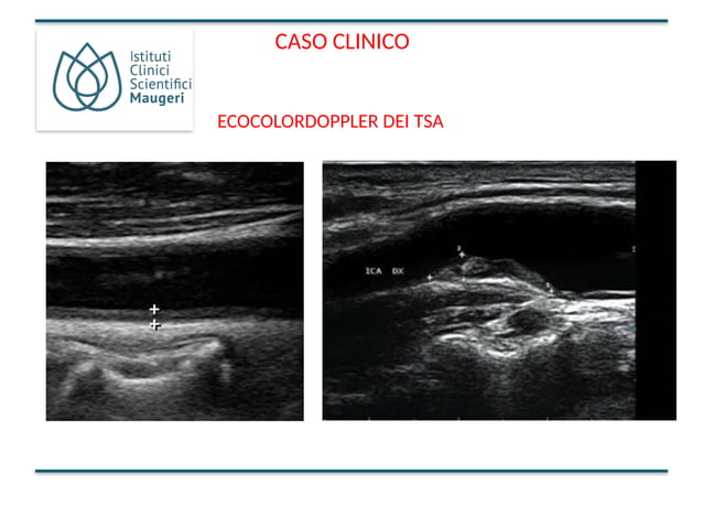 caso clinico doppler TSA eco vascolare cardiologia | PPT