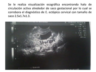 Caso clinico embarazo ectópico cervical | PPTX