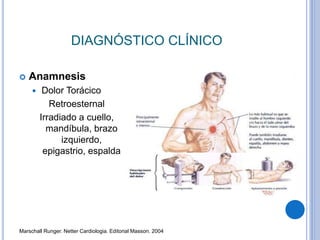 DOLOR TORACICO: SINDROME CORONARIO AGUDO, Caso clinico emergencias | PPTX