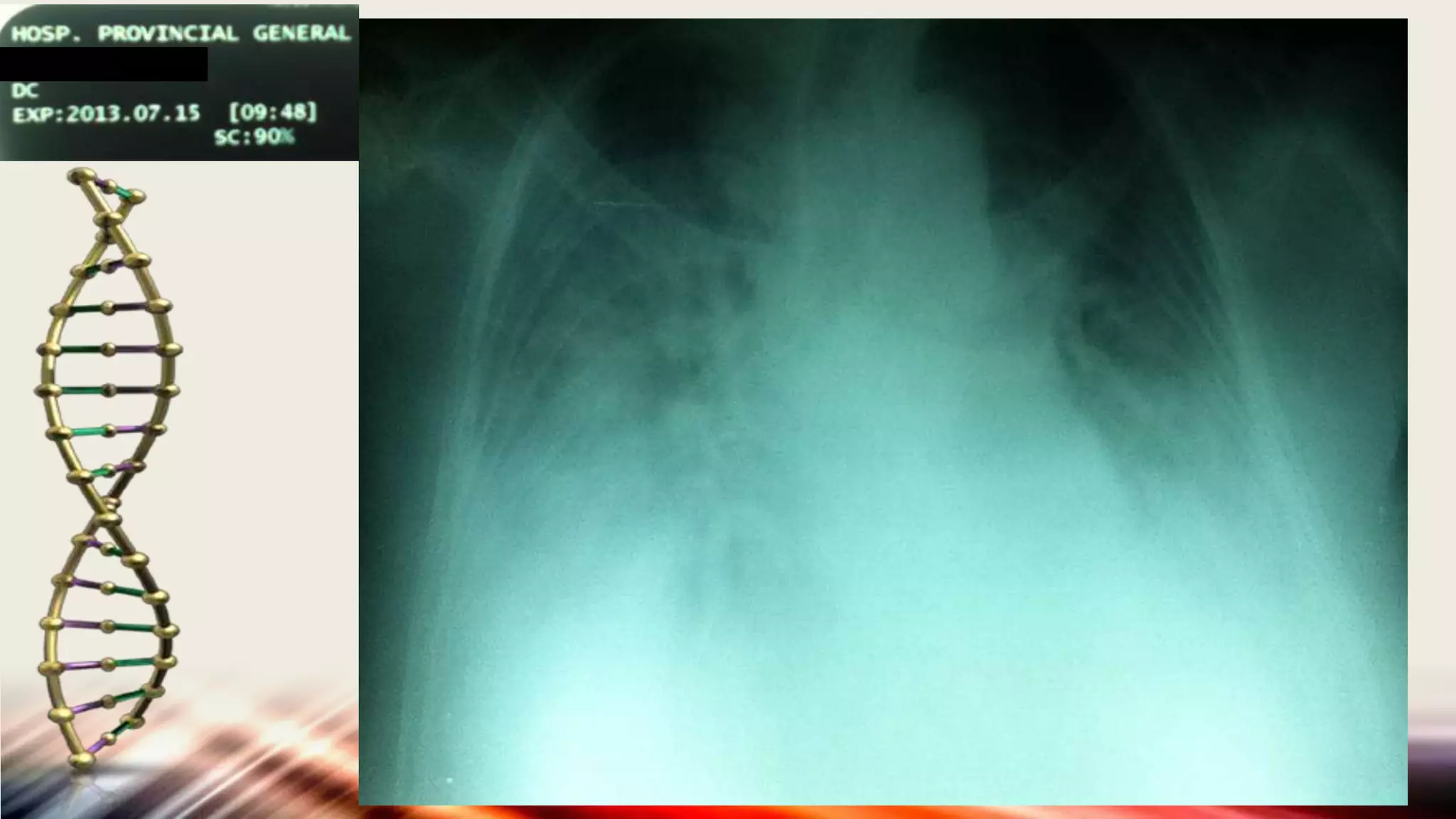 Caso clinico fistula entero cutánea (estercorácea) | PPT