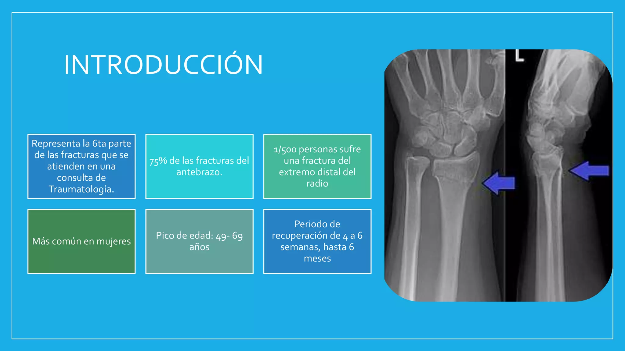 CASO CLINICO fx de radio distal.pptx
