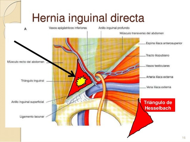 Diagnóstico de hernia inguinal por TC