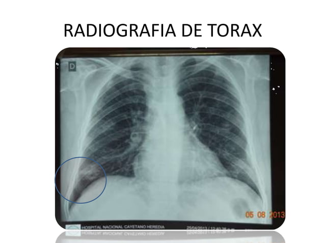 Caso clinico medicina interna criptococosis diseminada | PPT