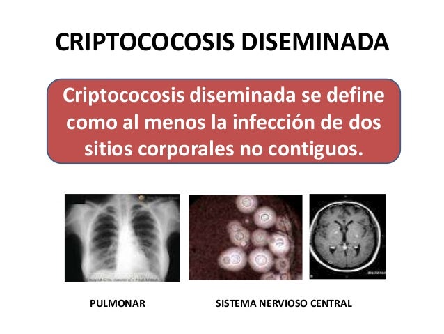 Caso clinico medicina interna criptococosis diseminada
