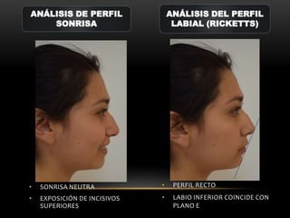 Caso clinico ortodoncia | PPSX