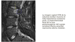CASO CLINICO OSTEOMA gabriela Valdivia V. | PPTX
