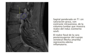 CASO CLINICO OSTEOMA gabriela Valdivia V. | PPTX