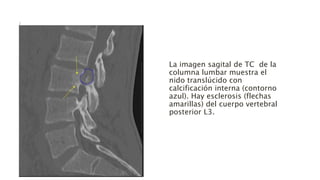 CASO CLINICO OSTEOMA gabriela Valdivia V. | PPTX