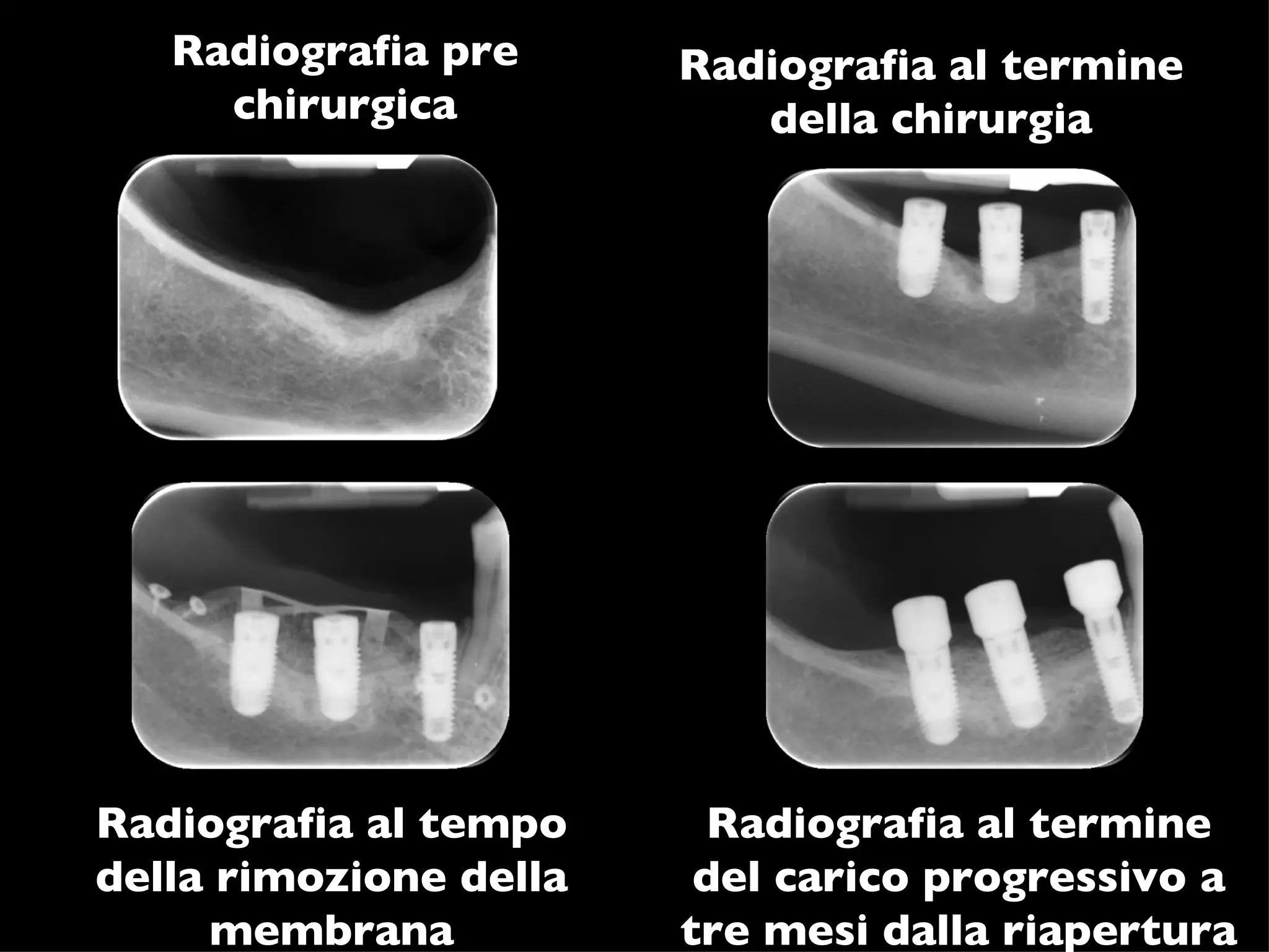 GBR Verticale nella mandibola posteriore. Case report. | PPT