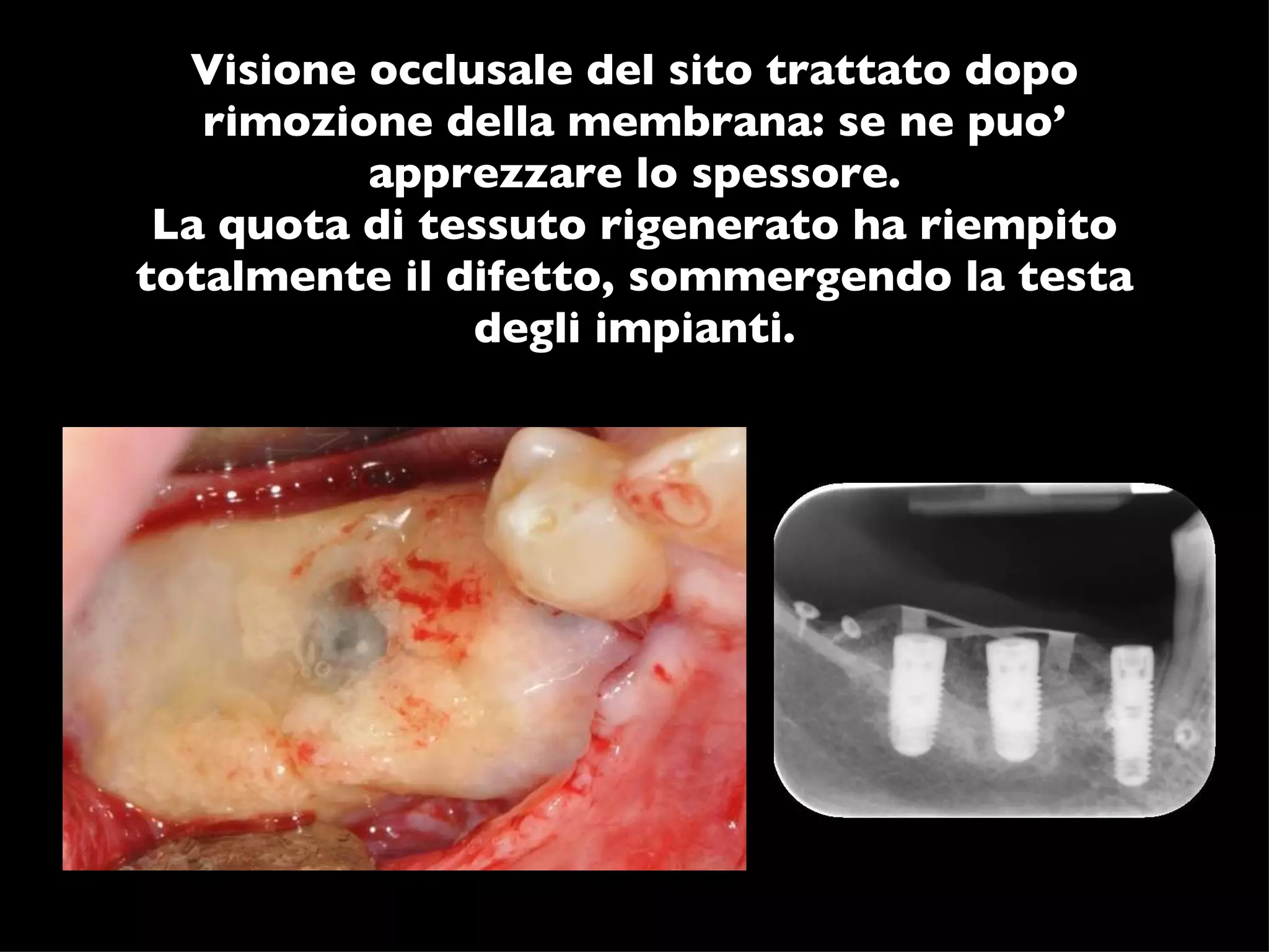 GBR Verticale nella mandibola posteriore. Case report. | PPT