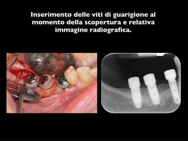 GBR Verticale nella mandibola posteriore. Case report. | PPT | Free ...