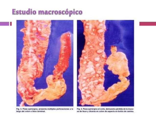 Caso clínico colitis amebiana
