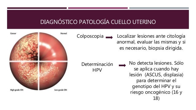 Caso clínico cáncer de cérvix