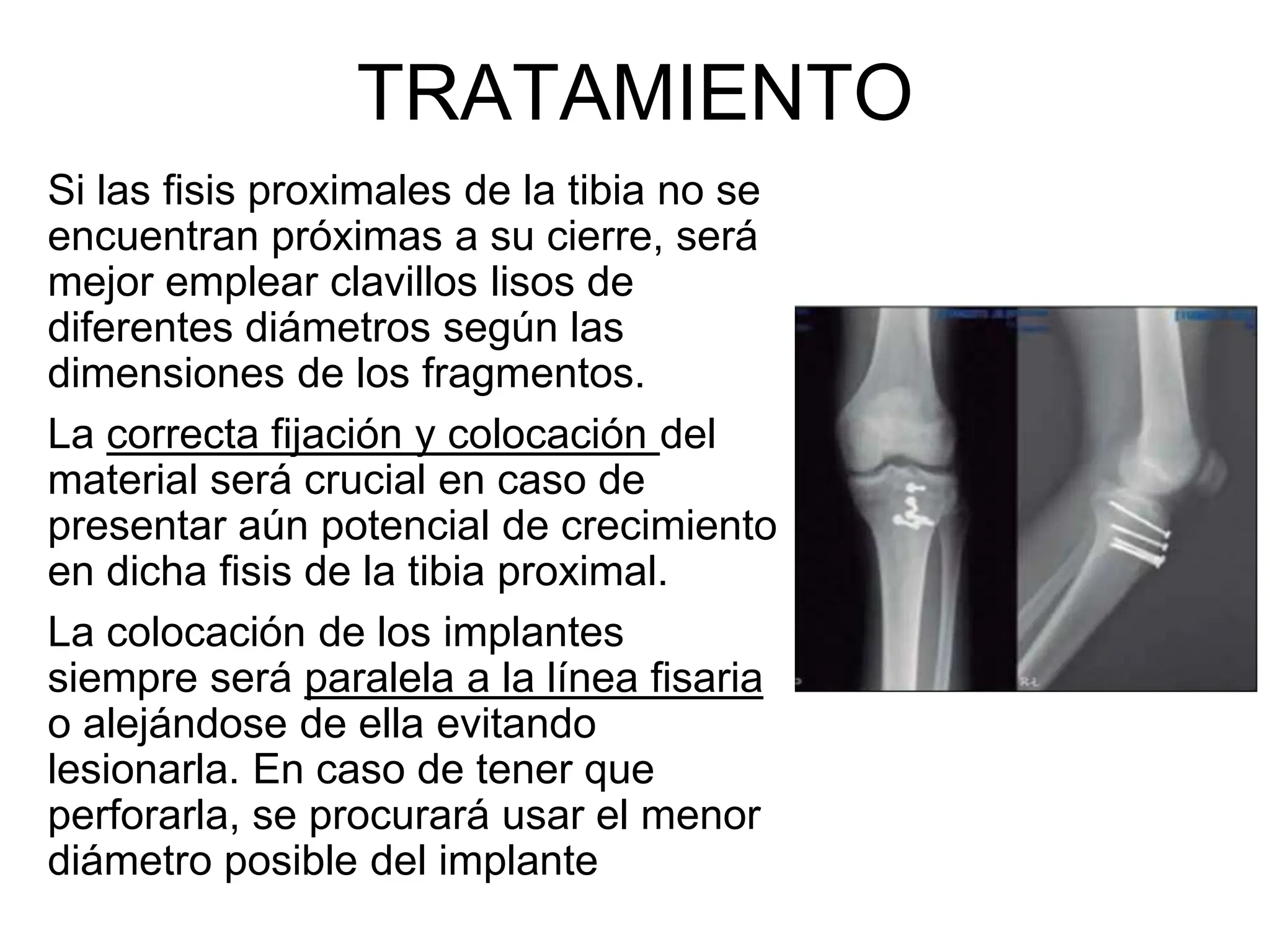 Caso clínico de fractura por avulsión de la tuberosidad tibial anterior ...
