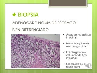 Caso clínico de enfermedad por reflujo gastroesofágico (Trabajo de ...