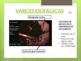 Caso clínico de hemorragia digestiva alta (Trabajo de Digestivo. Curso ...