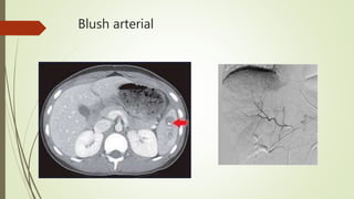 Caso clinico- Trauma hepático- tratamento não operatório | PPT