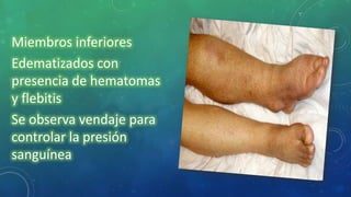Caso clínico trombo flebitis arterovenosa profunda | PPTX