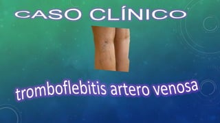 Caso clínico trombo flebitis arterovenosa profunda | PPTX