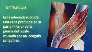 Caso clínico trombo flebitis arterovenosa profunda | PPTX