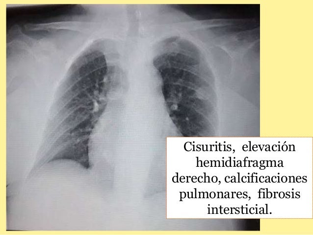 Caso clínico hipercalcemia sindrome de hueso hambriento