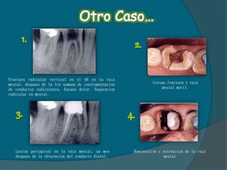 Caso Clinico Fractura Vertical | PPTX