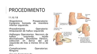 Presentación de Caso "Gangrena en Diabetes" | PPTX