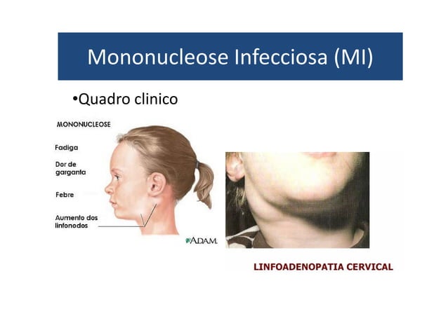 Mononucleose Infecciosa | PPT