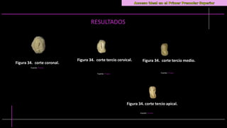 caso preclinico corte transversal del primer premolar superior.pptx