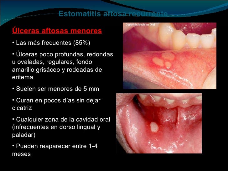 Que Es Estomatitis Aftosa Recurrente - Citas Adultos En Valencia