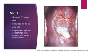 CASOS CLINICOS COLPOSCOPIA.pptx