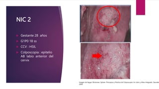 CASOS CLINICOS COLPOSCOPIA.pptx