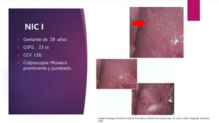CASOS CLINICOS COLPOSCOPIA.pptx