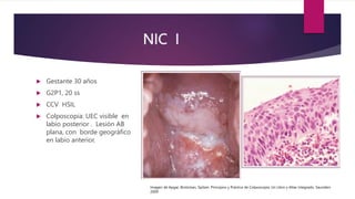 CASOS CLINICOS COLPOSCOPIA.pptx