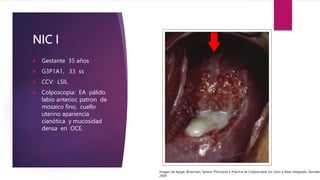 CASOS CLINICOS COLPOSCOPIA.pptx