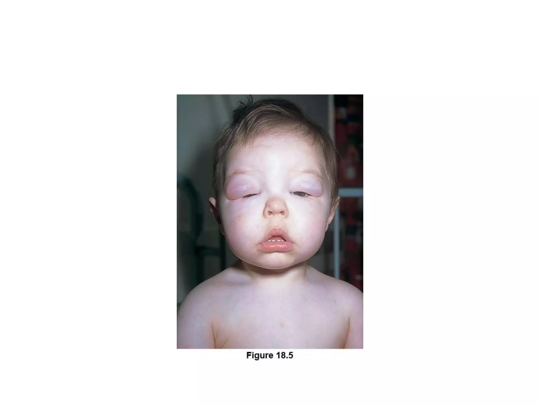 Casos clinicos edema | PPTX | Medical Health