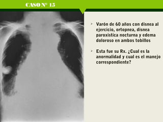 CASOS CLINICOS RADIOGRAFIAS DE TORAX by Rudy Paucara | PPT