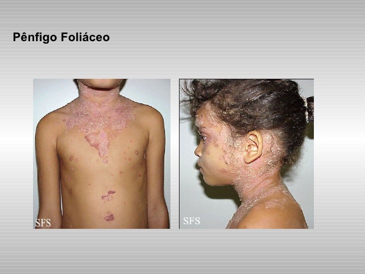 Casos ClíNicos Em Dermatologia