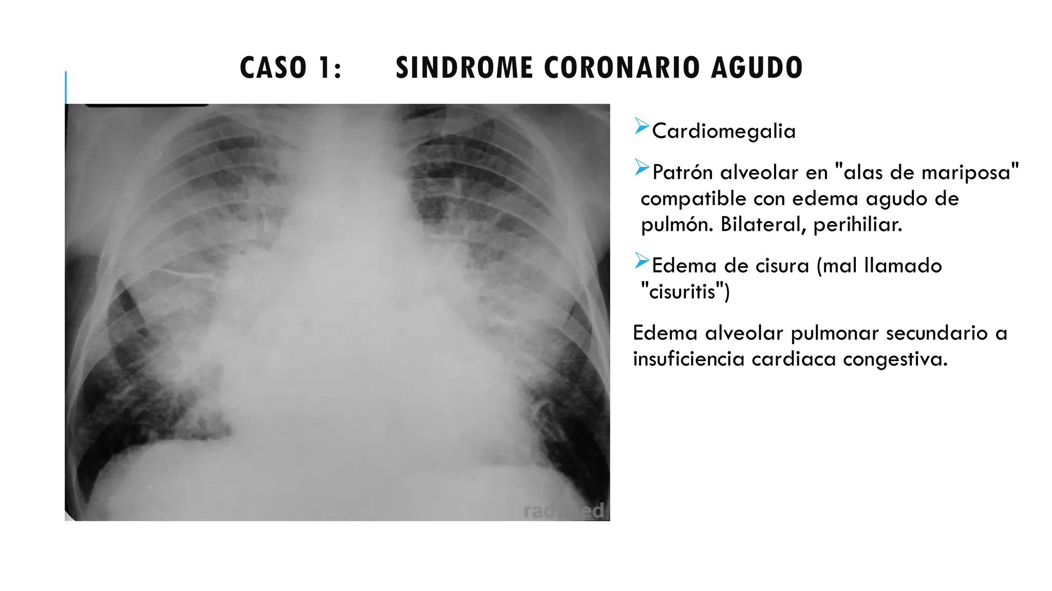 Casos Disnea Agudapptx El Sistema Respiratorio Ppt