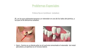 Casos Especiales Prótesis Fija | PPTX