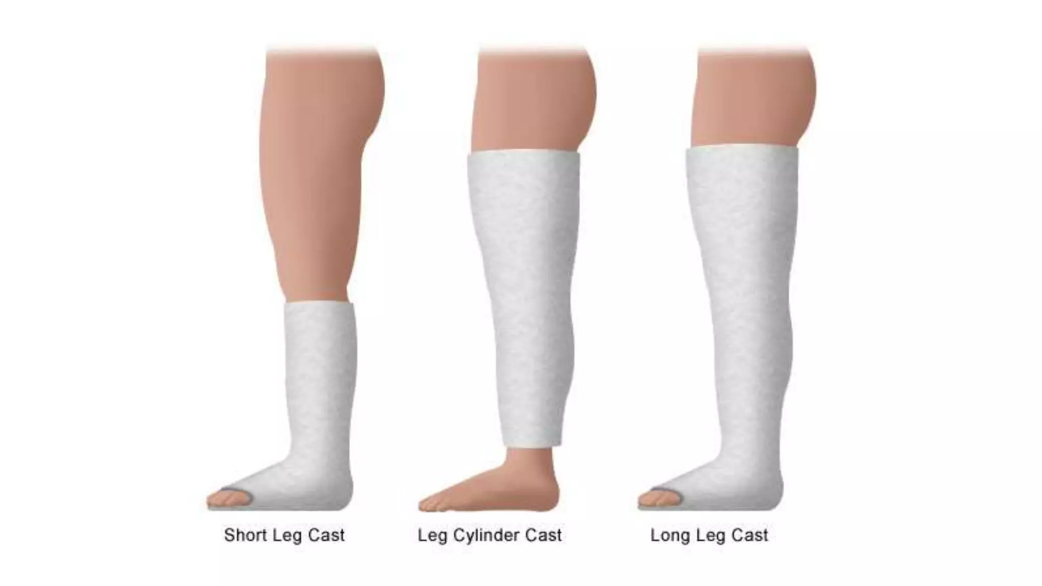 Cast and immobilization techniques in orthopaedics by Dr O.O. Afuye | PPTX