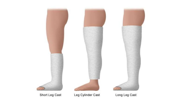 Cast and immobilization techniques in orthopaedics by Dr O.O. Afuye | PPTX