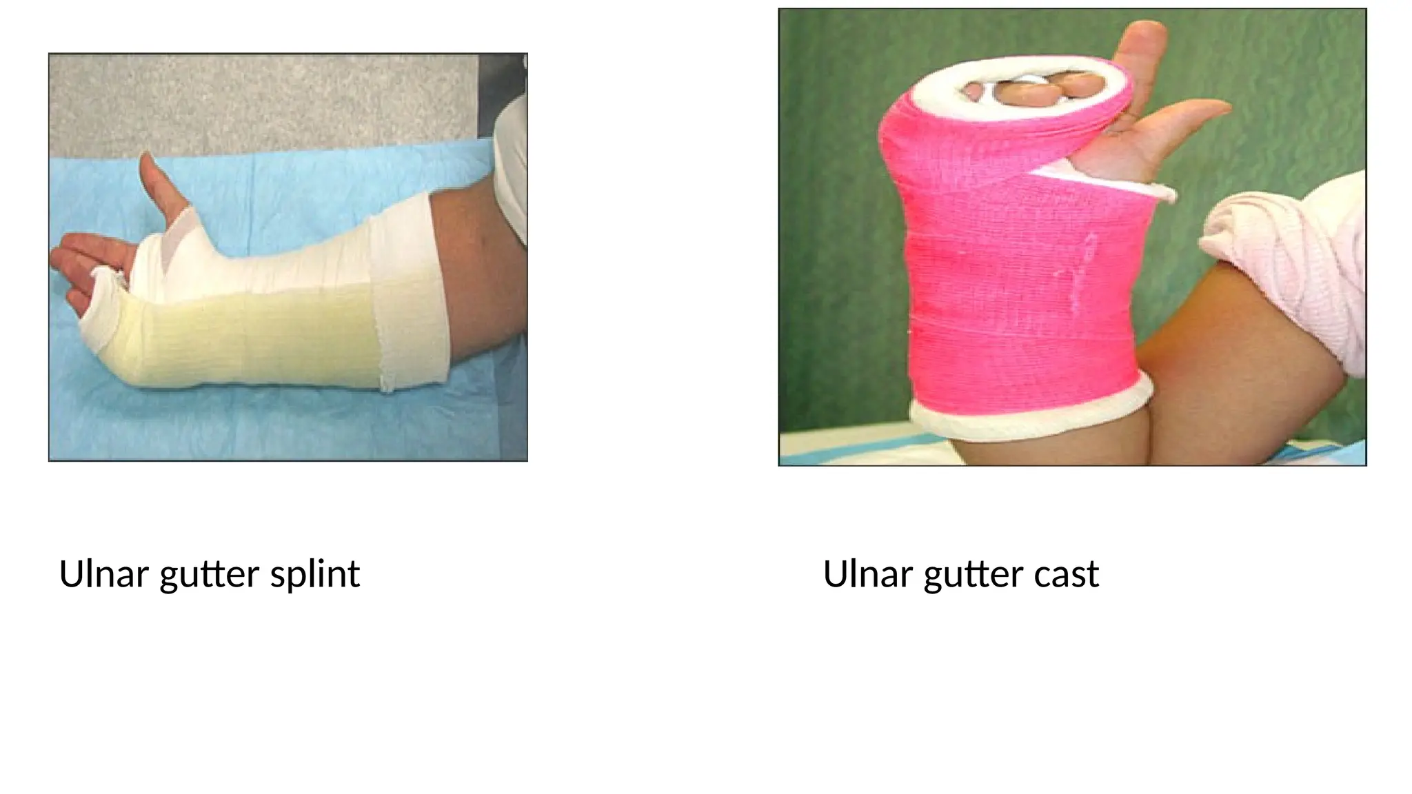 Types, definition of different CAST AND SPLINT- | PPTX
