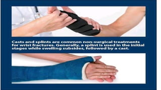 Types, definition of different CAST AND SPLINT- | PPTX