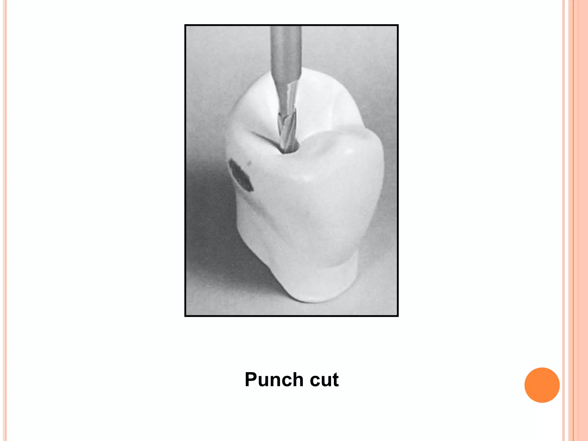 Cast gold Inlay restorations | PPTX