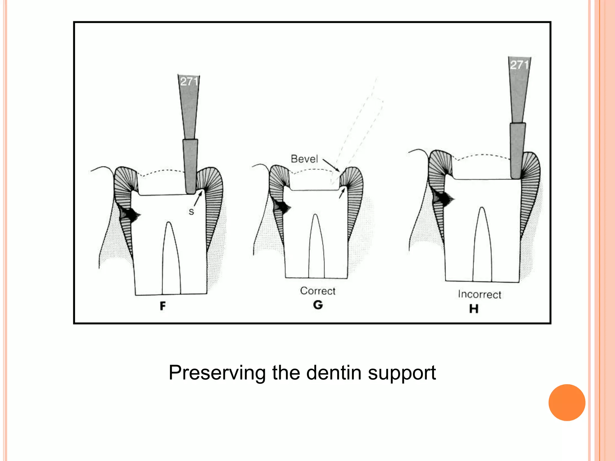 Cast gold Inlay restorations | PPTX