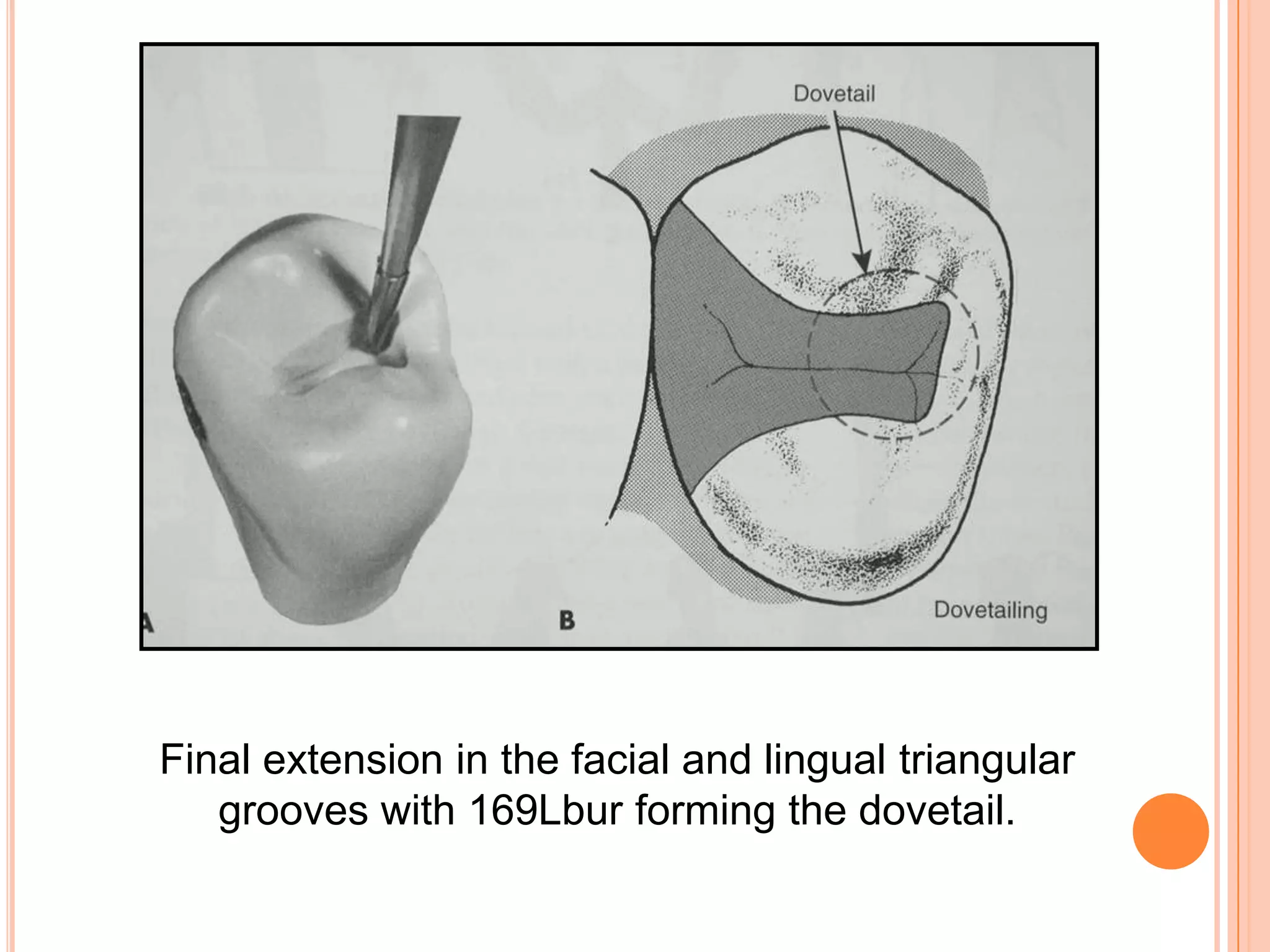 Cast gold Inlay restorations | PPTX