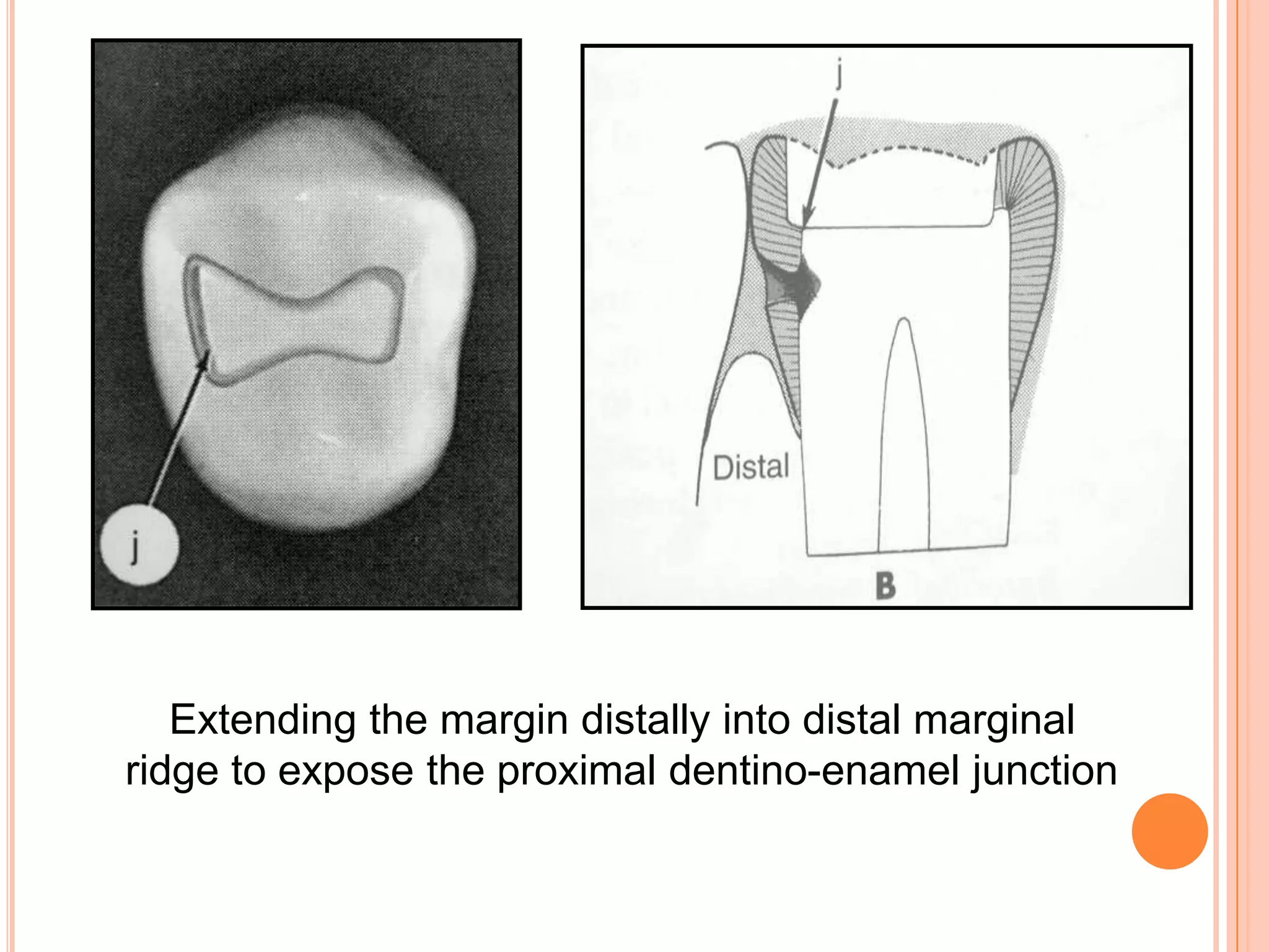 Cast gold Inlay restorations | PPTX