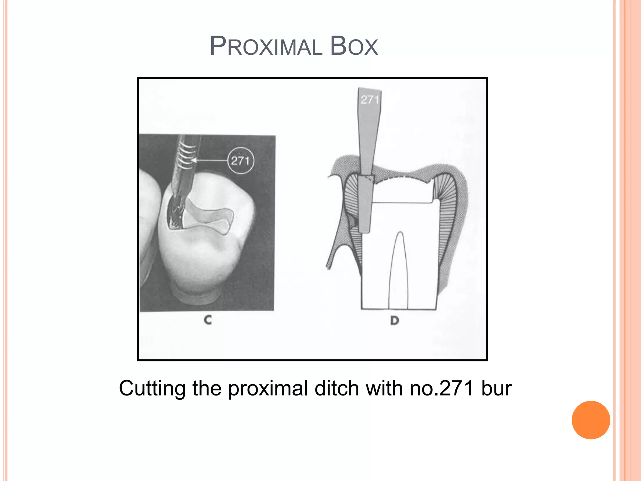 Cast gold Inlay restorations | PPTX